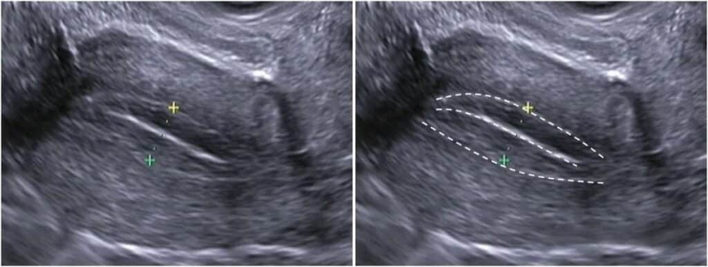 Uterine Lining in Embryo Transfer: A Guide for Surrogates and Intended ...